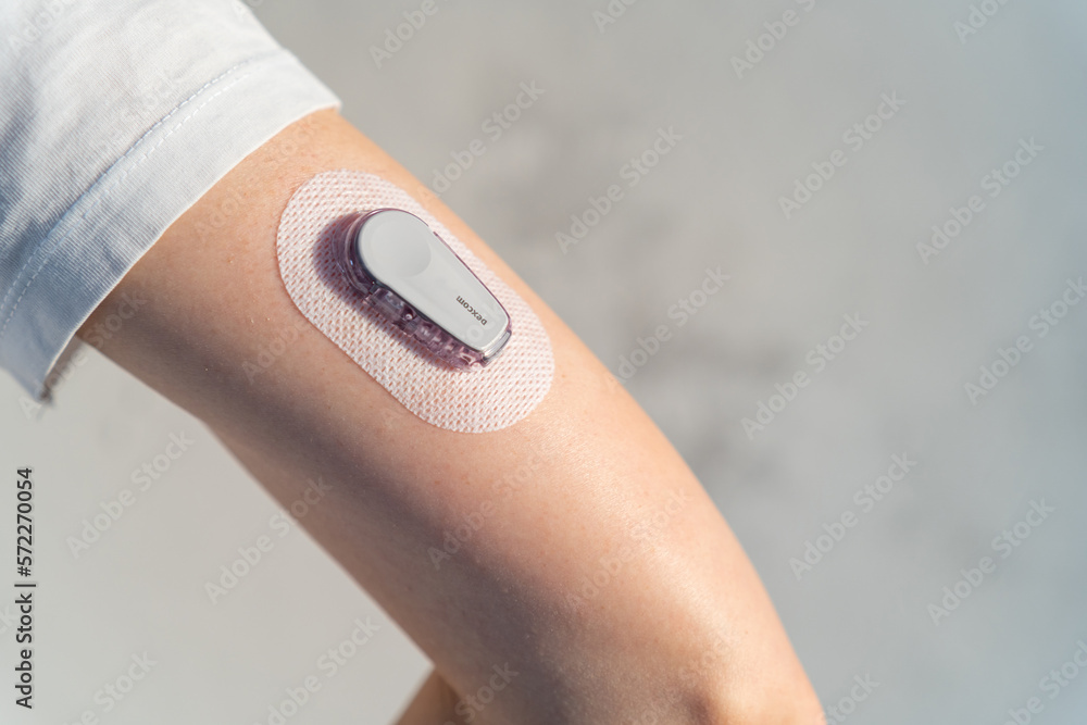 MINSK, BELARUS - FEBRUARY, 2023: Continuous Glucose Monitoring Dexcom ...