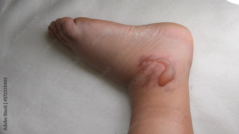 Swollen leg with blisters filled with fluid after frostbite close-up ...