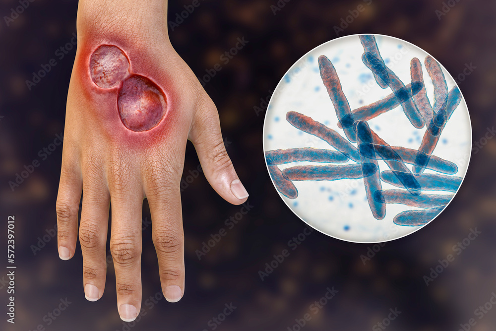 Buruli ulcer on an arm, 3D illustration. The disease caused by ...