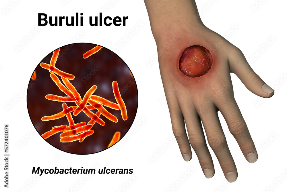 Buruli ulcer on an arm, 3D illustration. The disease caused by ...