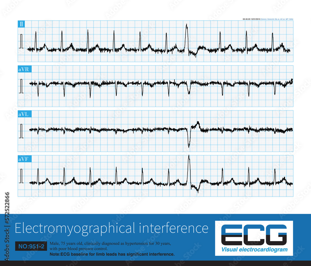 When the baseline of ECG is interfered by its own or external ...