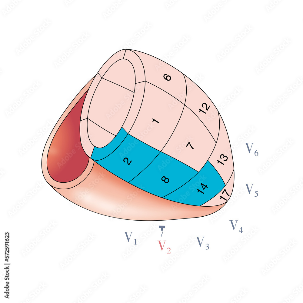 In the case of acute anterior septal or anterior myocardial infarction ...