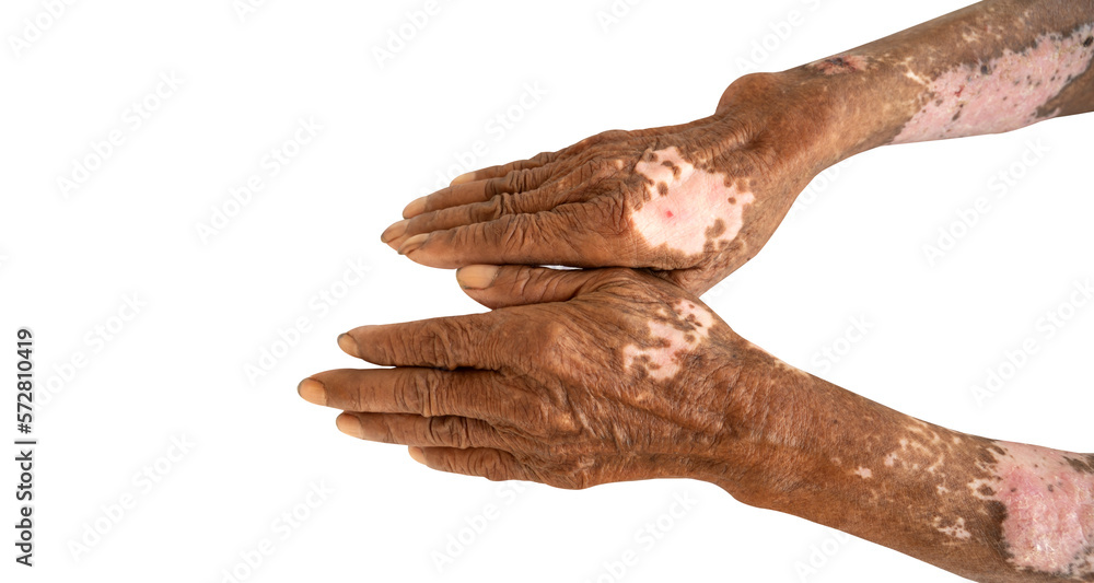 White spotted skin disease on hand and arm asian man isolated on white ...