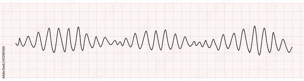 EKG Monitor Showing Polymorphic Ventricular tachycardia or VT: Torsades ...