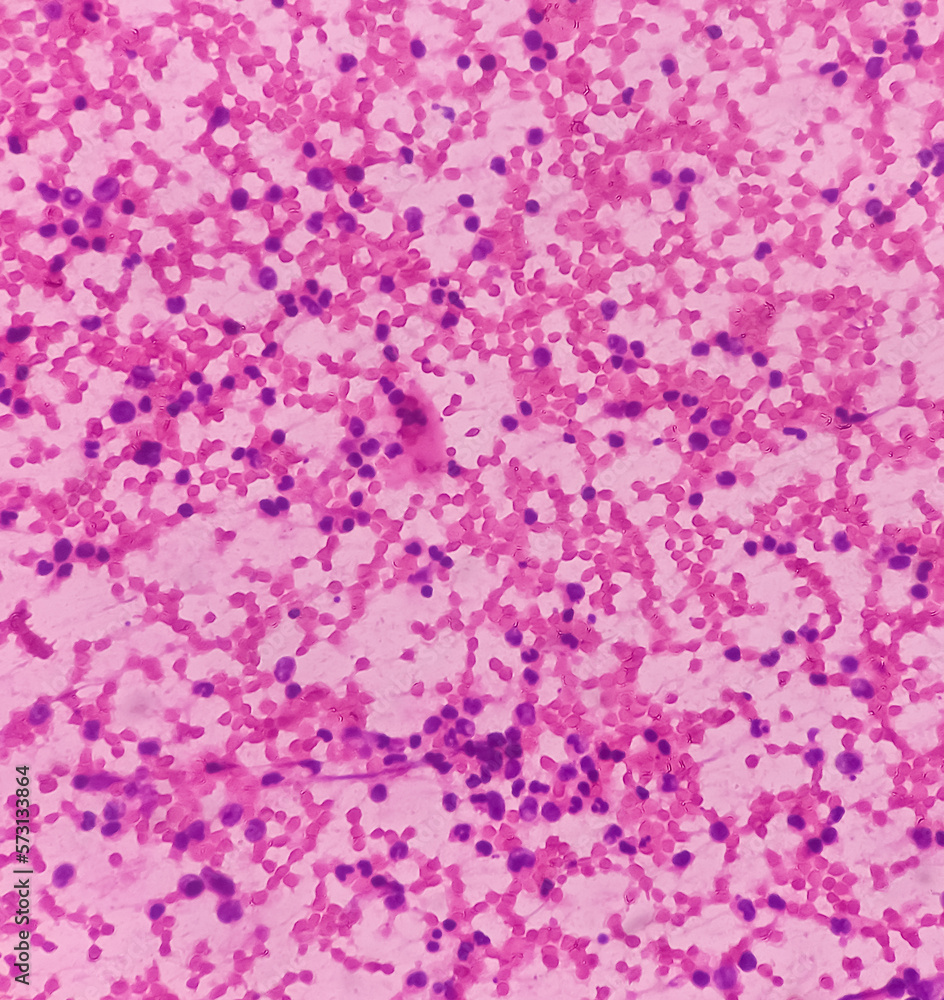 Gluteal region Tumor Cytology. Myeloid sarcoma. Chronic myeloid ...