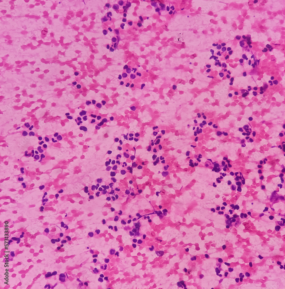 Gluteal region Tumor Cytology. Myeloid sarcoma. Chronic myeloid ...