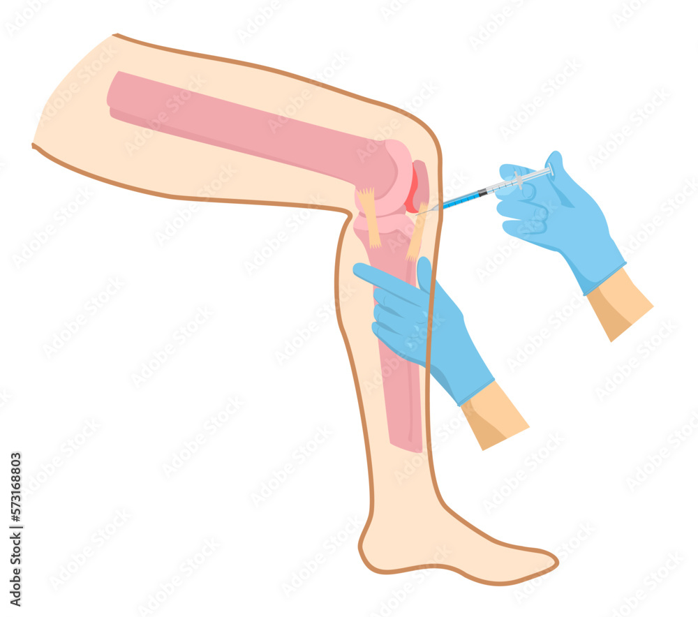 Knee injection inflammation redness vector illustration recovery. Knee injection concept ...