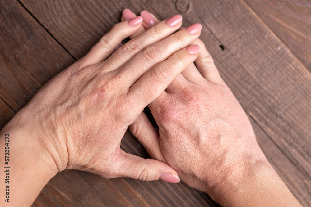 Extremely dry, dehydrated and cracked skin of a woman's hand. Allergy ...