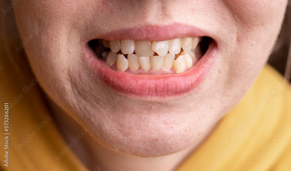 Curved female teeth, before installing braces. Close - up of teeth ...