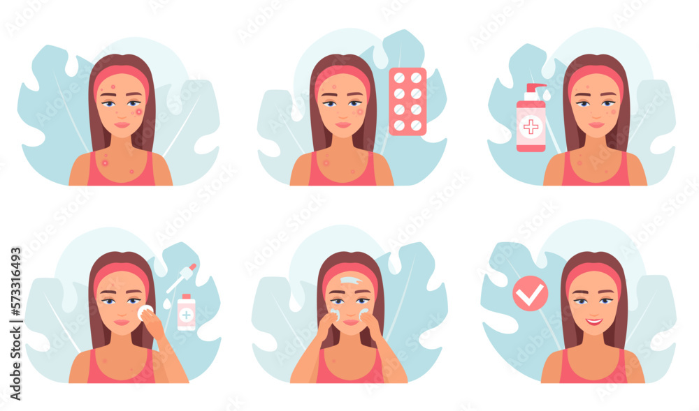 Acne treatment set vector illustration. Cartoon medical infographic ...