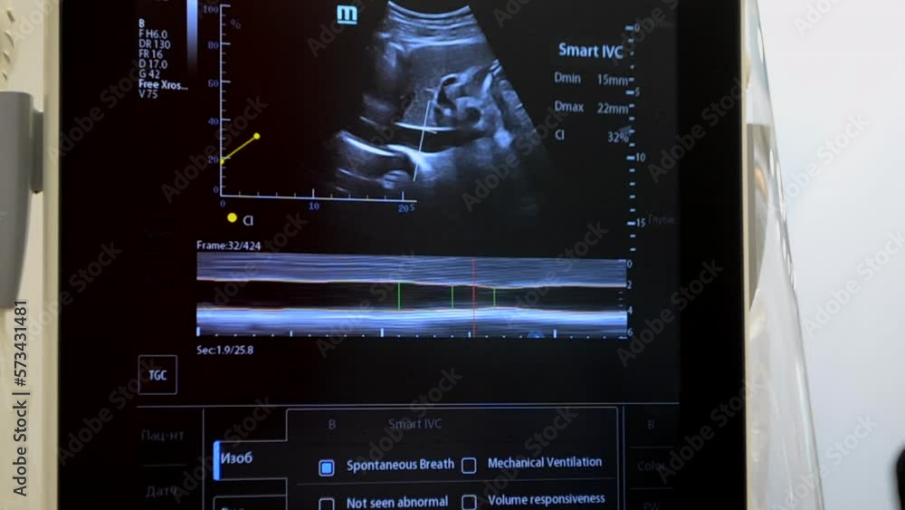 Utrasound image on the monitor close-up. Ultrasound Scan display ...