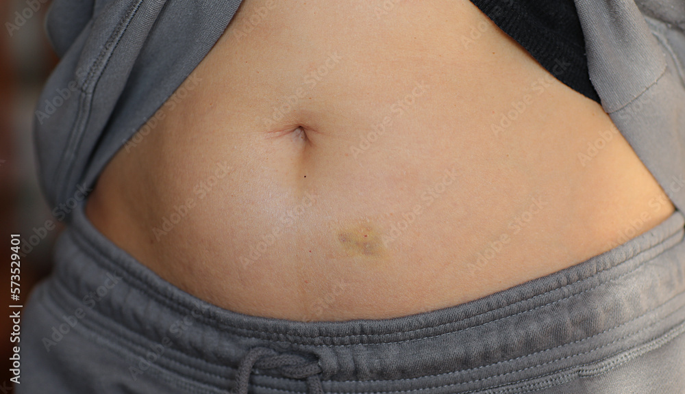 Adult woman with green yellow bruise, hematoma on her stomach at home ...