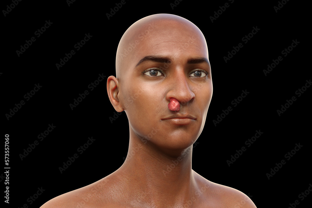 Nasal rhinosporidiosis in a patient, 3D illustration. A disease caused ...