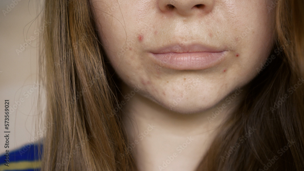 Foto de Close up of skin problems, unhealthy skin with acne and pimples ...