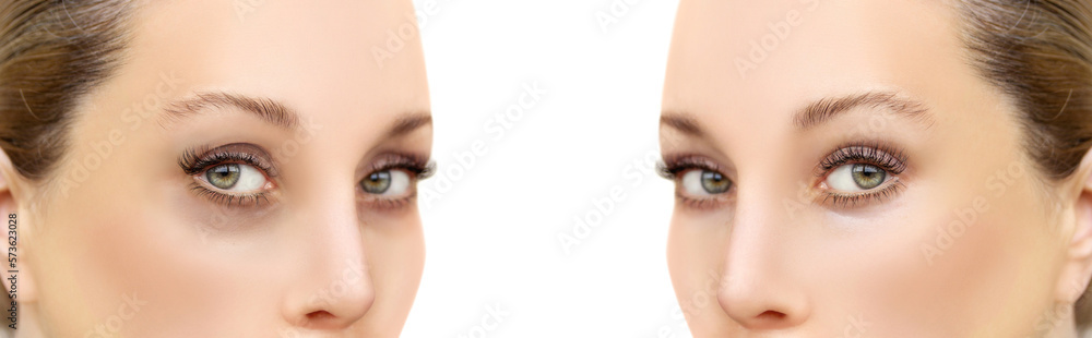 Tear Trough Filler,A-frame deformity. Fat grafting or dermal filler ...