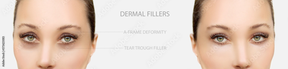 Tear Trough Filler,A-frame deformity. Fat grafting or dermal filler ...