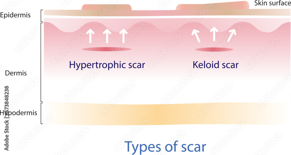 Type of keloid scar and hypertrophic scar on skin surface. Scars are caused by wounds that reach ...