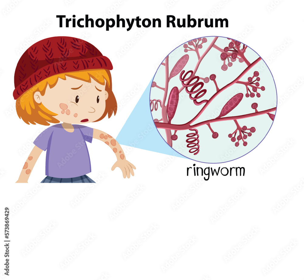 Trichophyton Rubrum fungal infection Stock Vector | Adobe Stock