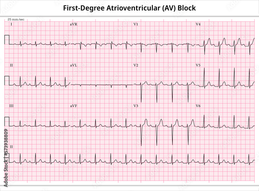 First Degree Atrioventricular Block - ECG Paper 12 Lead ...