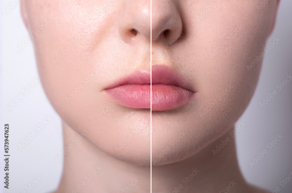 female thin lips before and after hyaluronic acid filler injection as ...