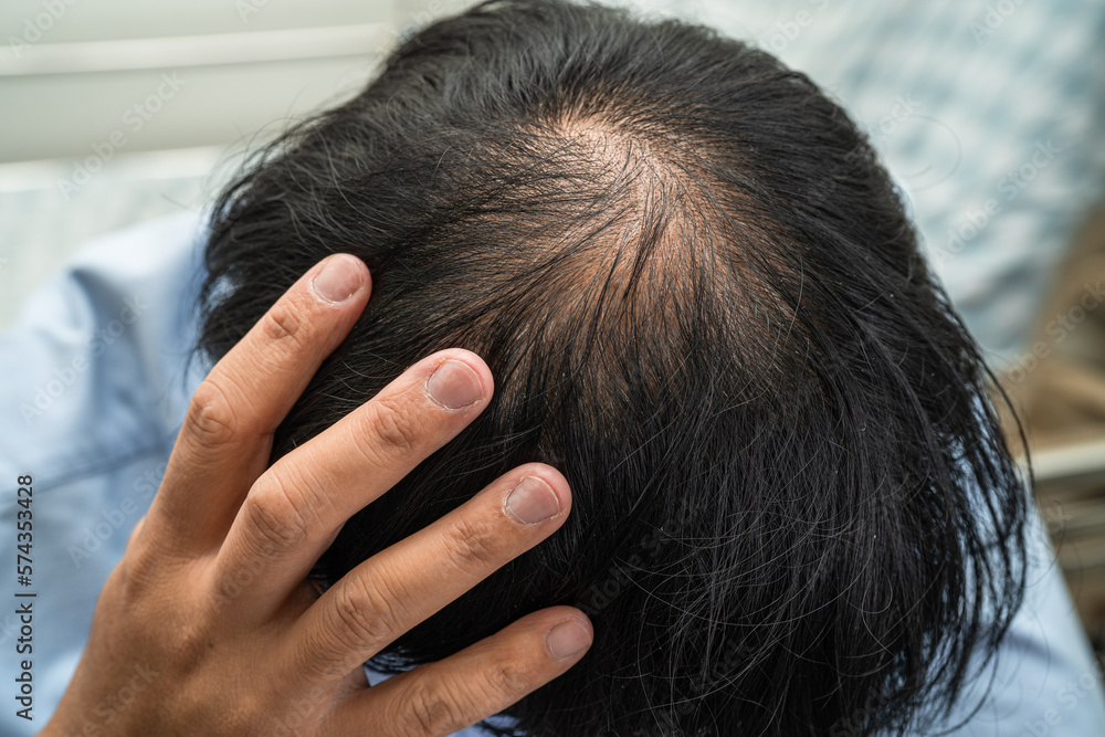 Bald in the middle head and begin no loss hair glabrous of mature Asian ...