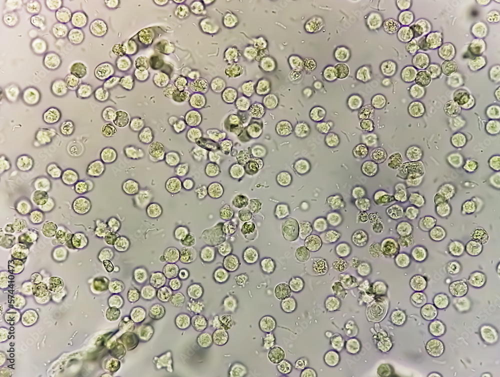 Pyuria or leukocyturia is the condition of urine containing white blood ...