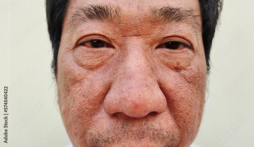 Foto de portrait showing the Freckles and blemish, dark spots and rough ...