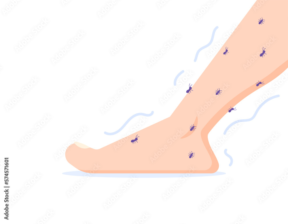 illustration of a foot that is swarmed by ants. tingling feet. health ...