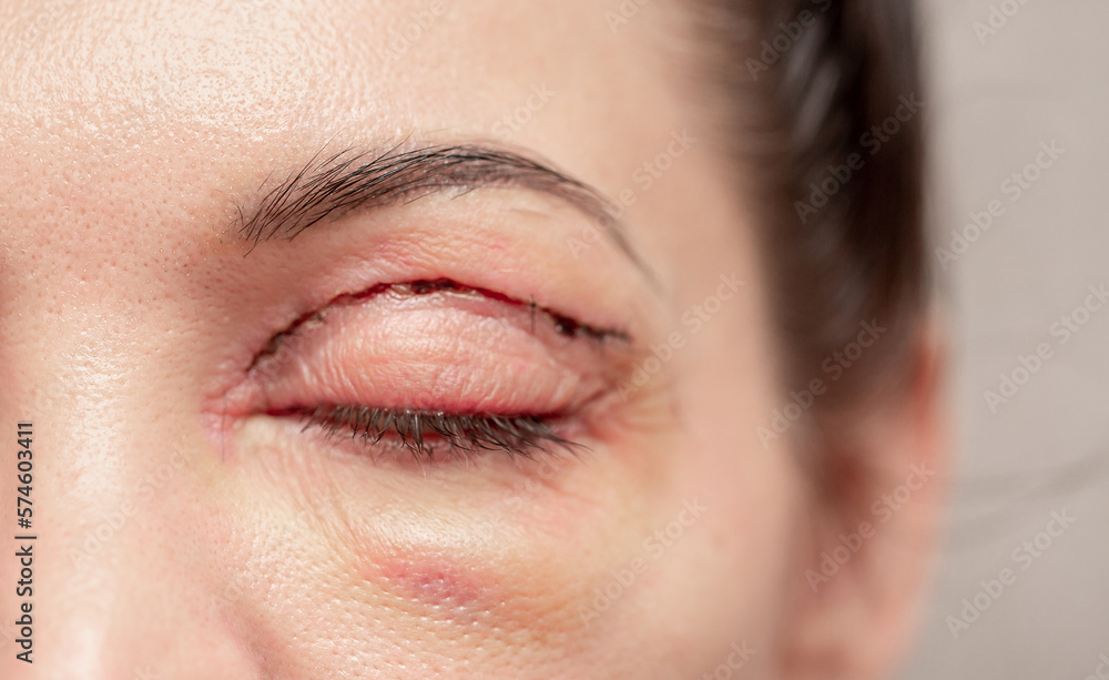 Plastic surgery of the face, skin tightening around the eyes. Surgical ...
