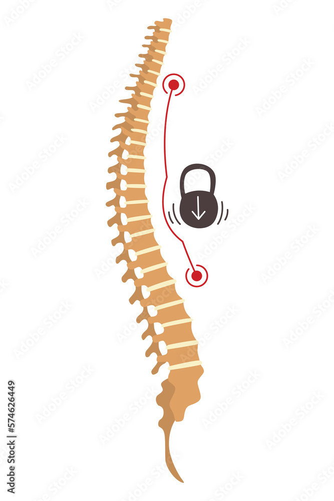 Spinal deformity. Symbol of spine curvatures or unhealthy backbones ...