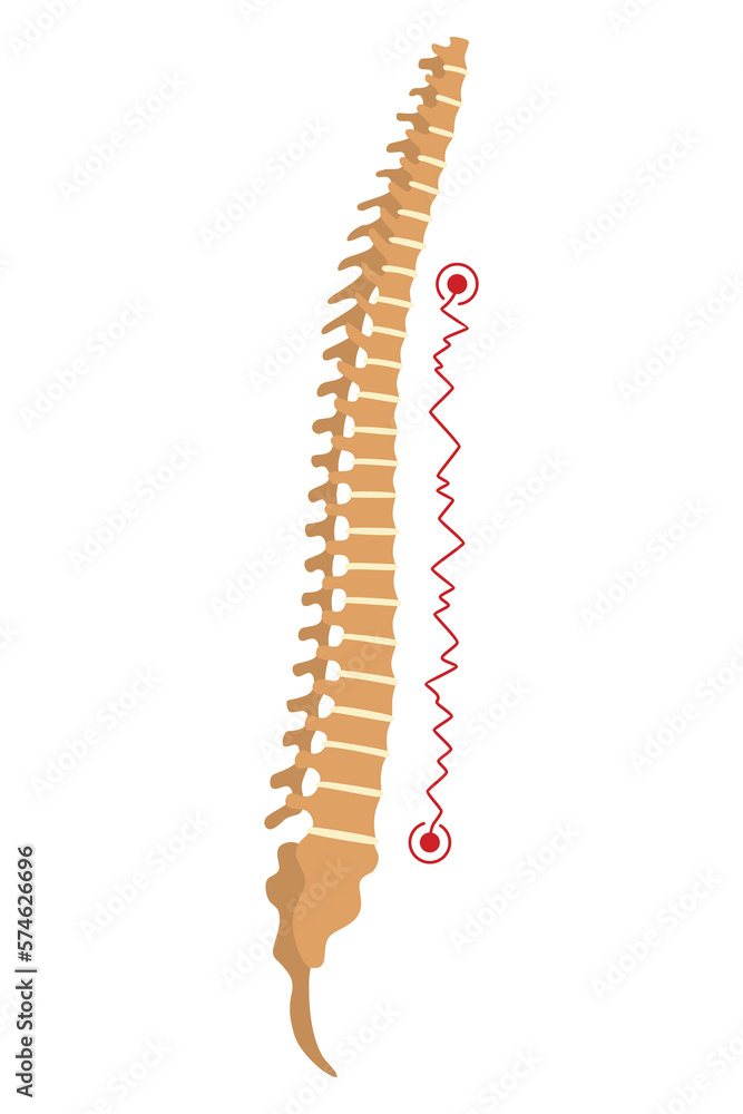 Spinal Deformity Symbol Of Spine Curvatures Or Unhealthy Backbones spinal-deformity-symbol-of-spine-curvatures-or-unhealthy-backbones