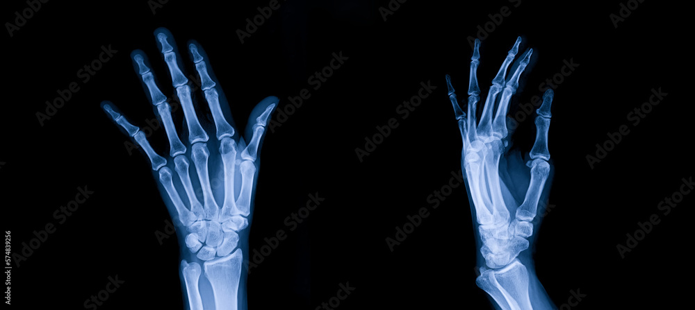 Osteoarthritis Hand Xray