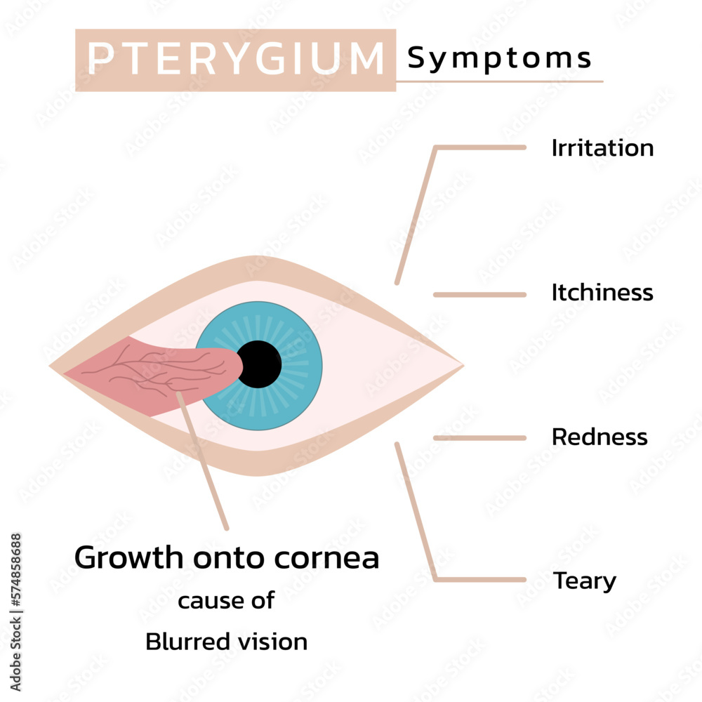 Pterygium signs and symptoms , vector Stock Vector | Adobe Stock Pterygium signs and symptoms , vector Stock Vector | Adobe Stock