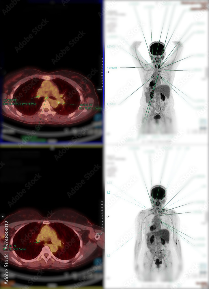 Poster Positron emission tomography (PET) CT scan uses a radioactive ...