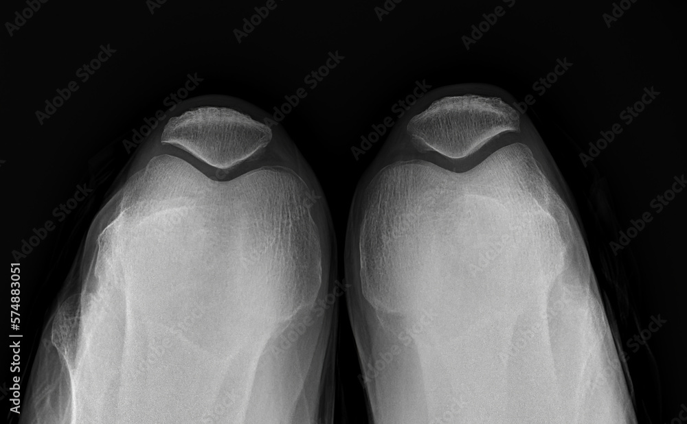 X-ray image of both knee AP view for diagnostic Osteoarthritis or knee ...