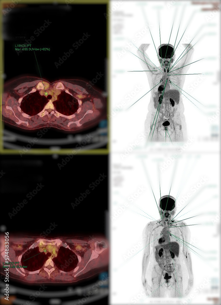 Positron emission tomography (PET) CT scan uses a radioactive drug ...