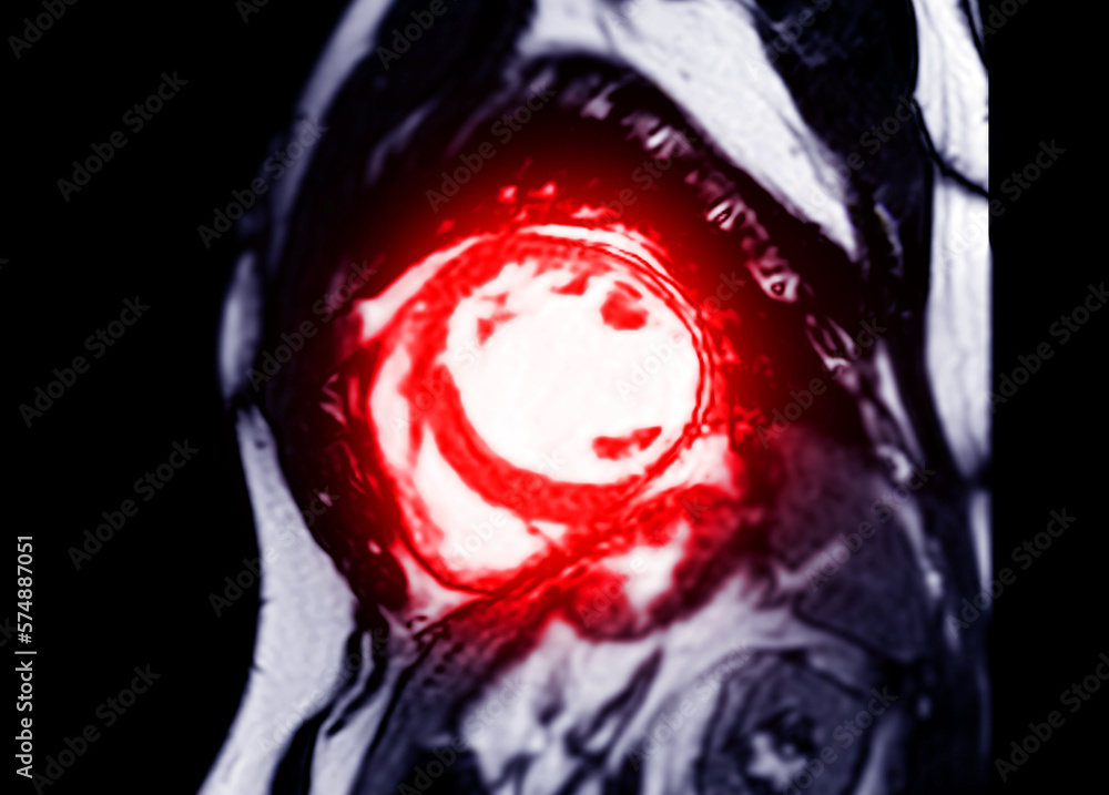 Mri Heart Or Cardiac Mri In Short Axis View Showing Cross Sections Of The Left And Right