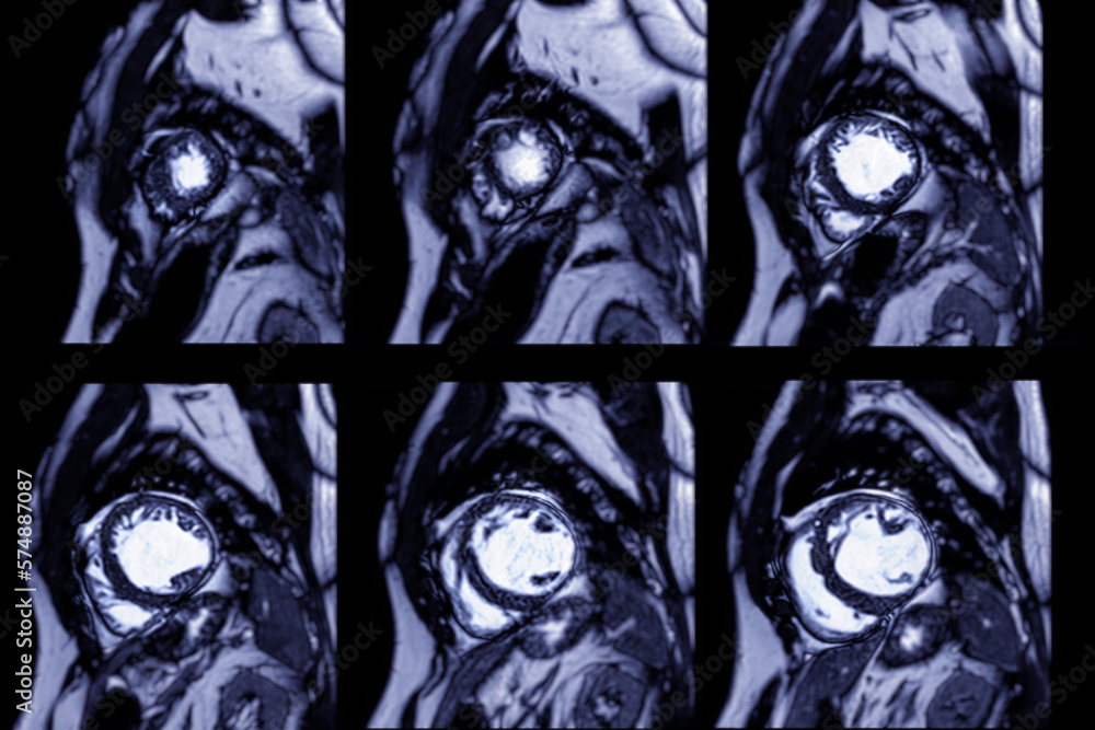 MRI heart or Cardiac MRI in short axis view showing cross-sections of ...