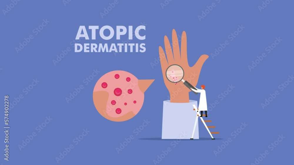 Dermatologist and Big Hand with Red Skin and Rash 2d animation in 4K ...
