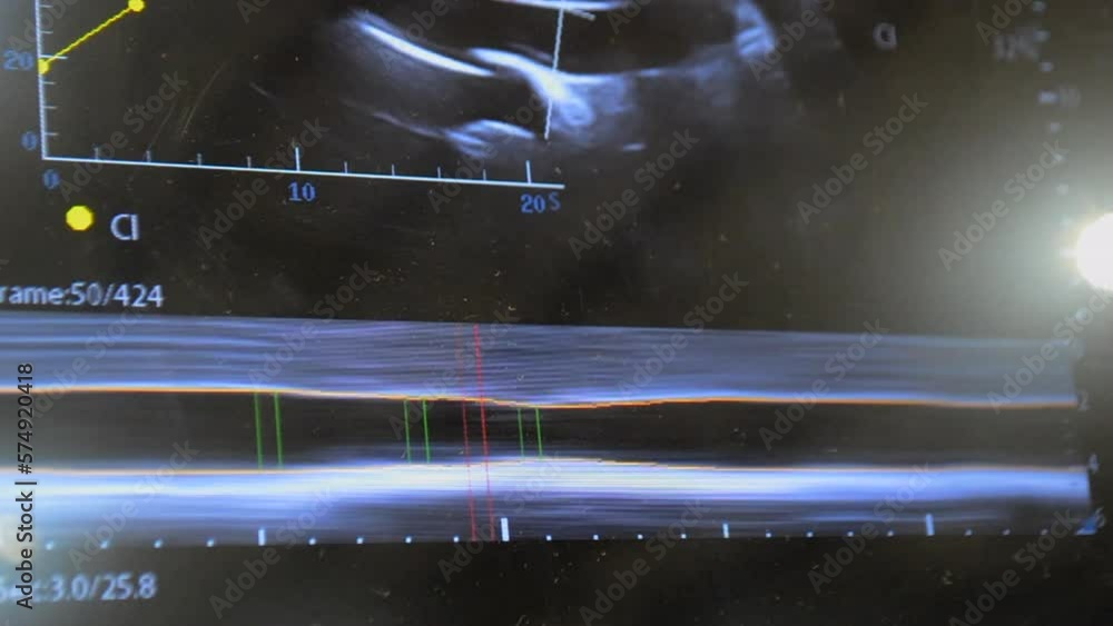 Utrasound image on the monitor close-up. Ultrasound Scan display ...