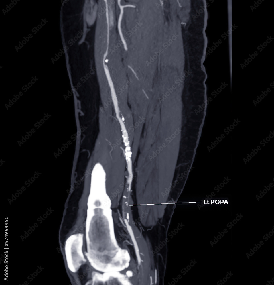 CTA femoral artery run off MPR curve showing Left femoral artery for ...