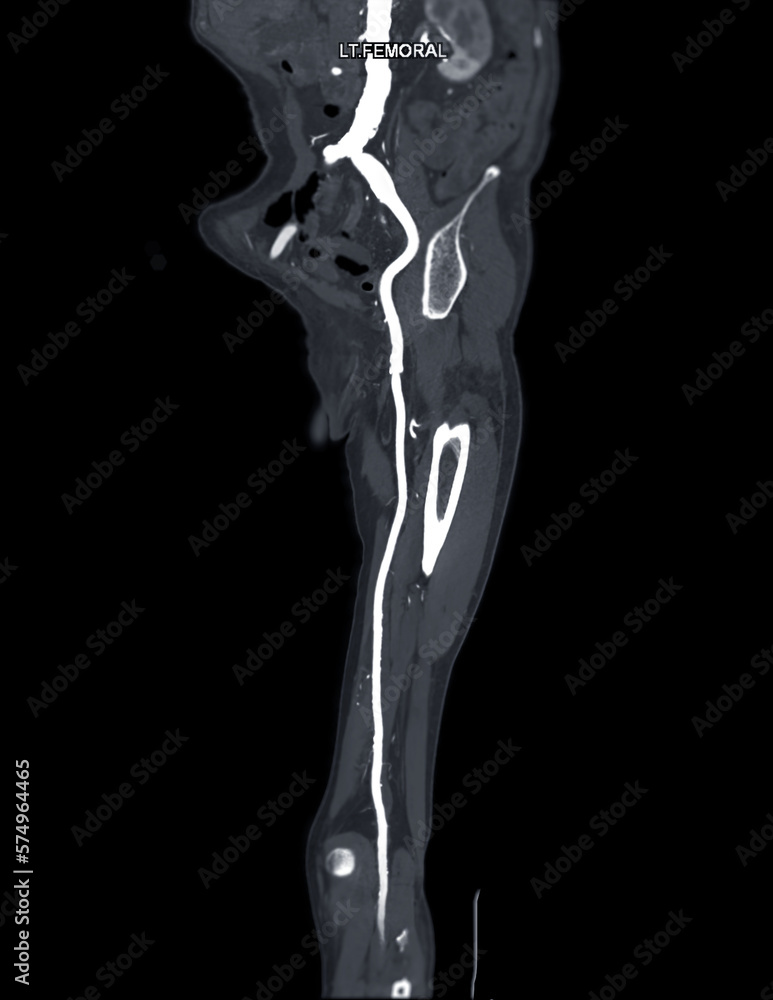 CTA femoral artery run off MPR curve showing Left femoral artery for ...