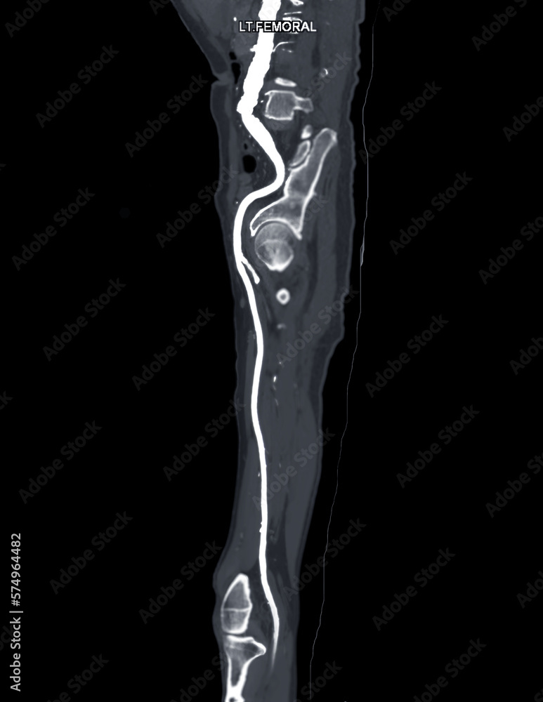 CTA femoral artery run off MPR curve showing Left femoral artery for ...