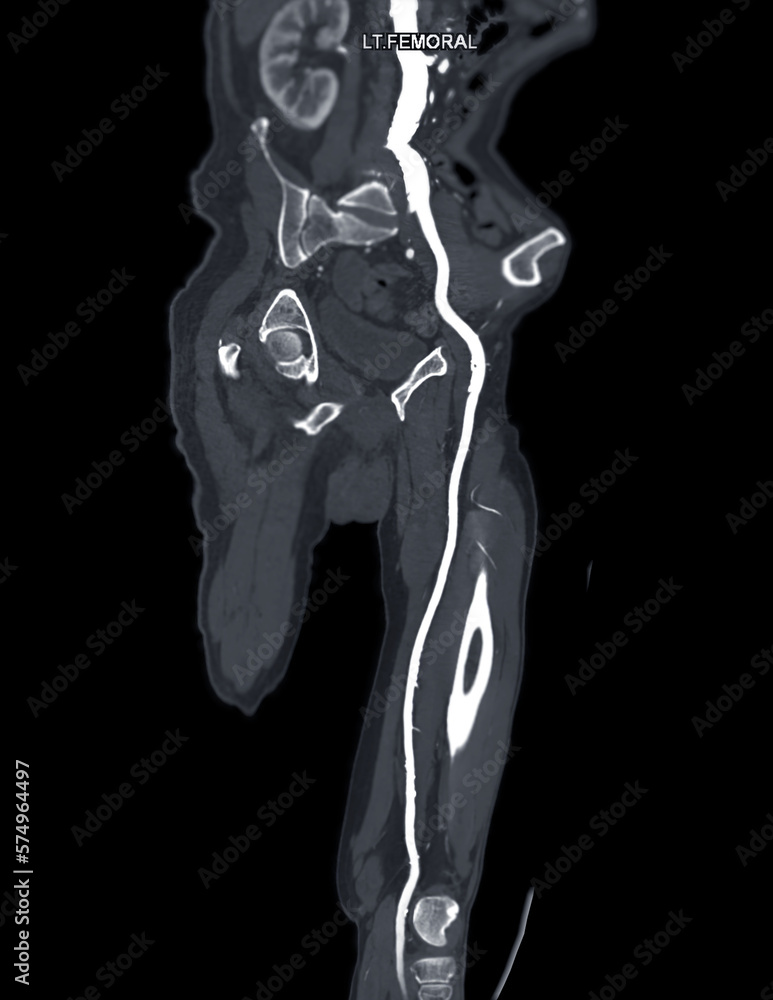 CTA femoral artery run off MPR curve showing Left femoral artery for ...