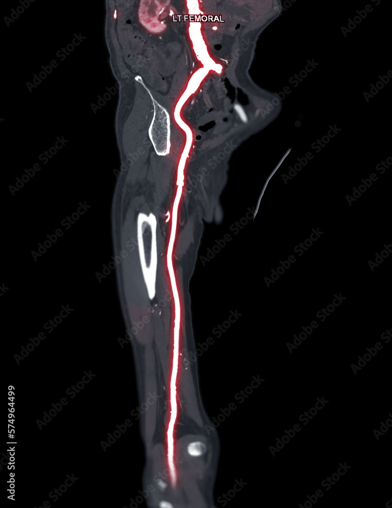 CTA femoral artery run off MPR curve showing Left femoral artery for ...