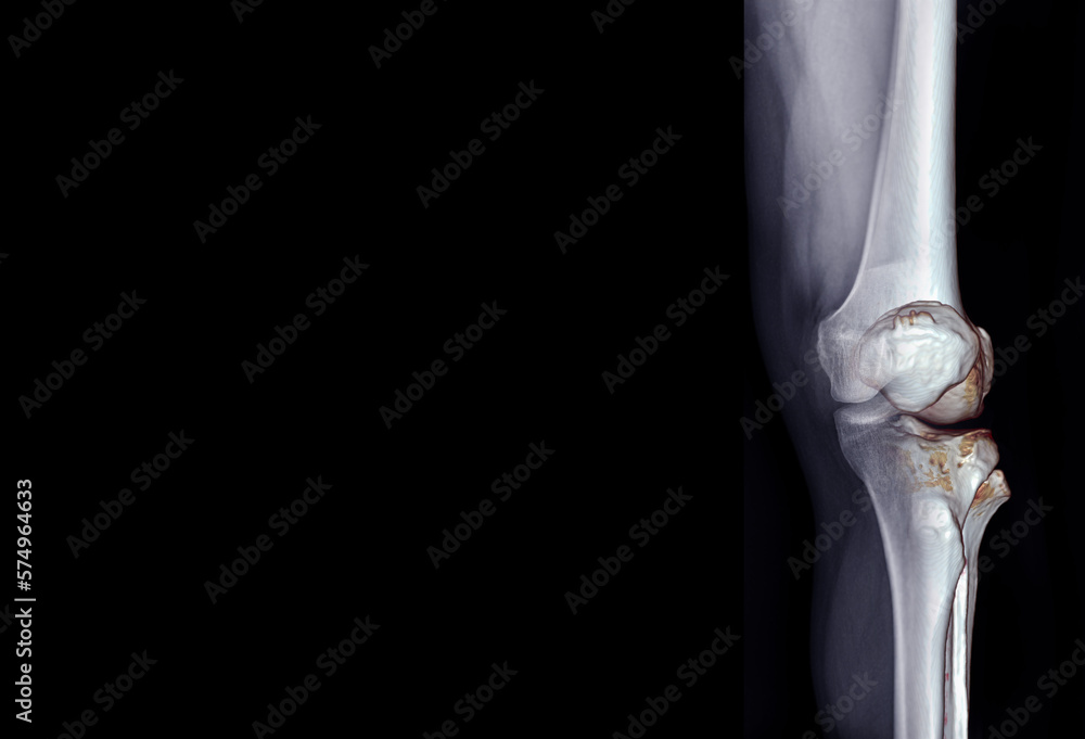 Film x-ray of knee joint AP view fusion with 3D rendering knee joint ...