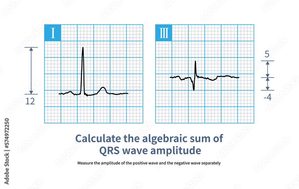 The calculation of algebraic sum of QRS wave is to measure the ...