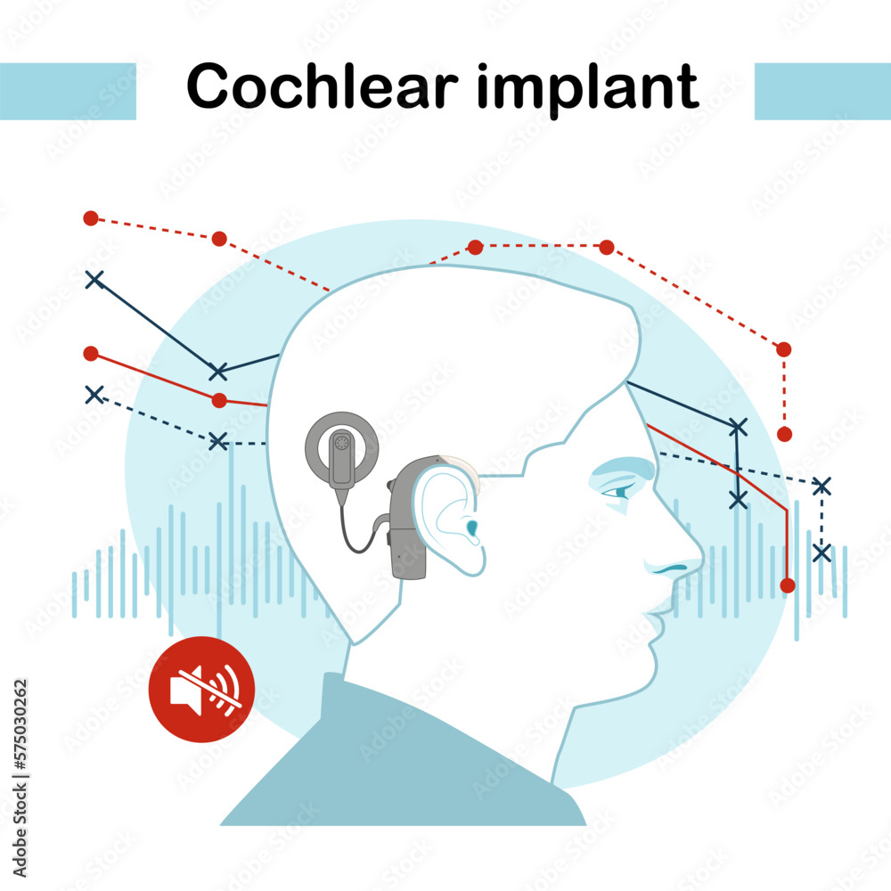 Head with a cochlear implant device in the ear. Cochlear implant device ...