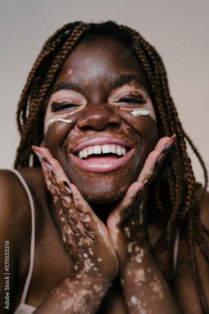 portrait of a pretty african woman with vitiligo smiling and posing ...