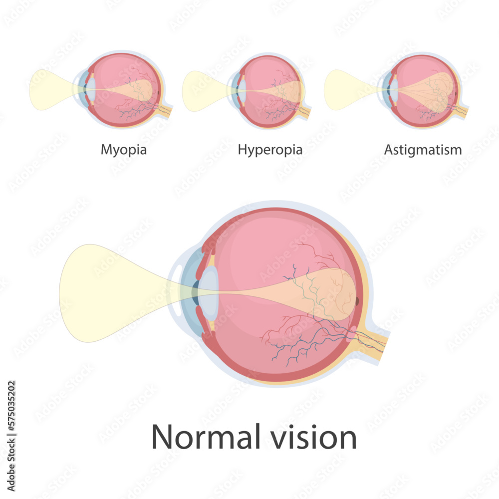 Ophthalmic concept, eye defects. Normal vision, Hyperopia, Myopia ...